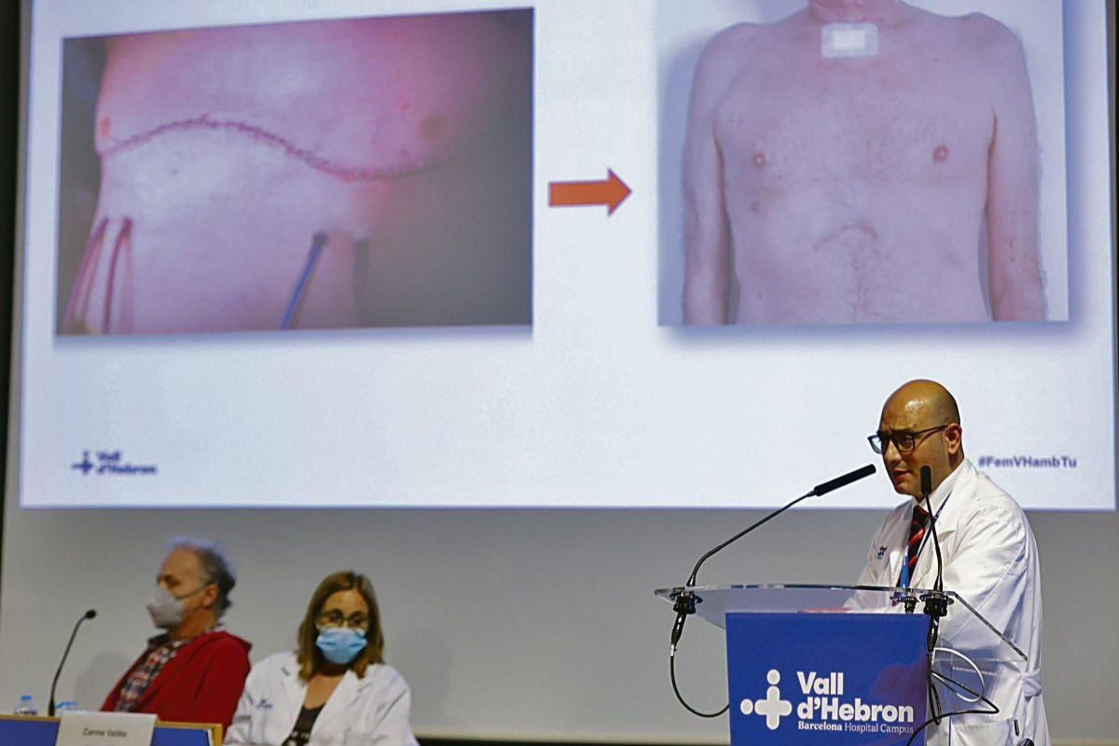 El primer trasplante robótico del mundo, en Vall d’Hebron