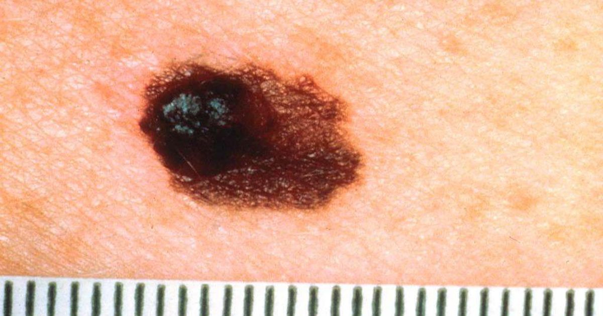 ¿Cómo distinguir un lunar benigno de uno maligno? Médicos de Ourense lo ...