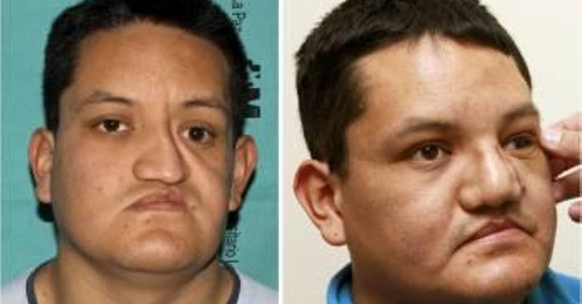 Prótesis de cerámica para reconstruir parte de la cara