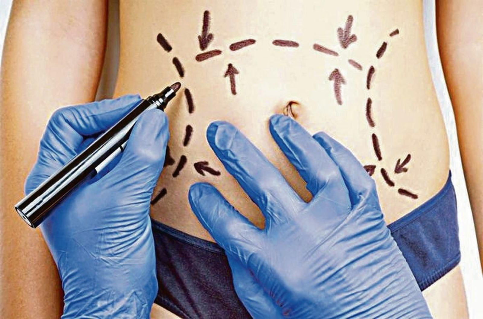 Ellas quieren liposucciones y ellos prefieren blefaroplastia